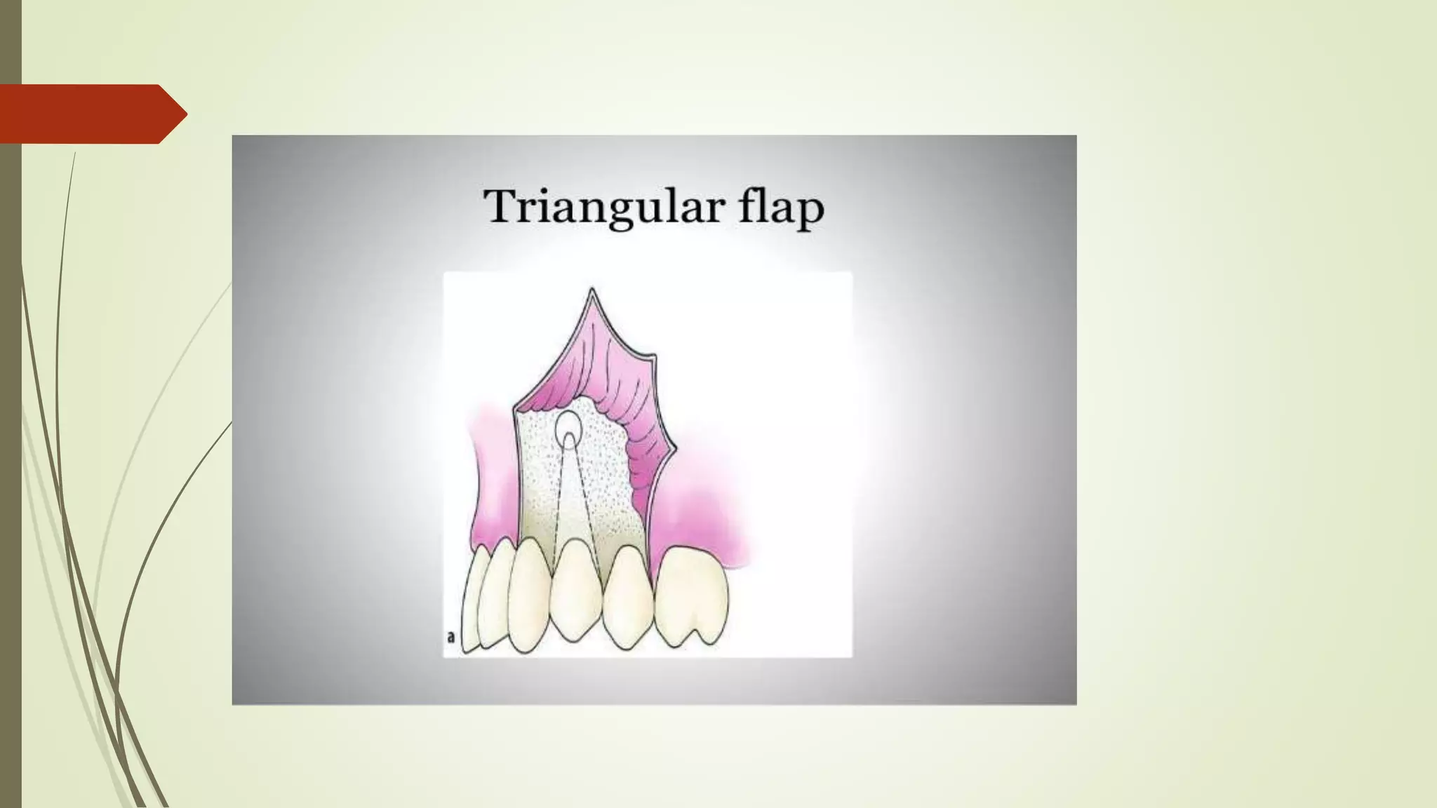 Flaps in oral surgery | PPTX