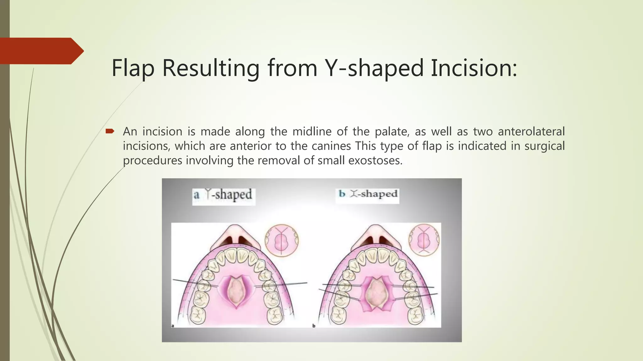 Flaps in oral surgery | PPTX