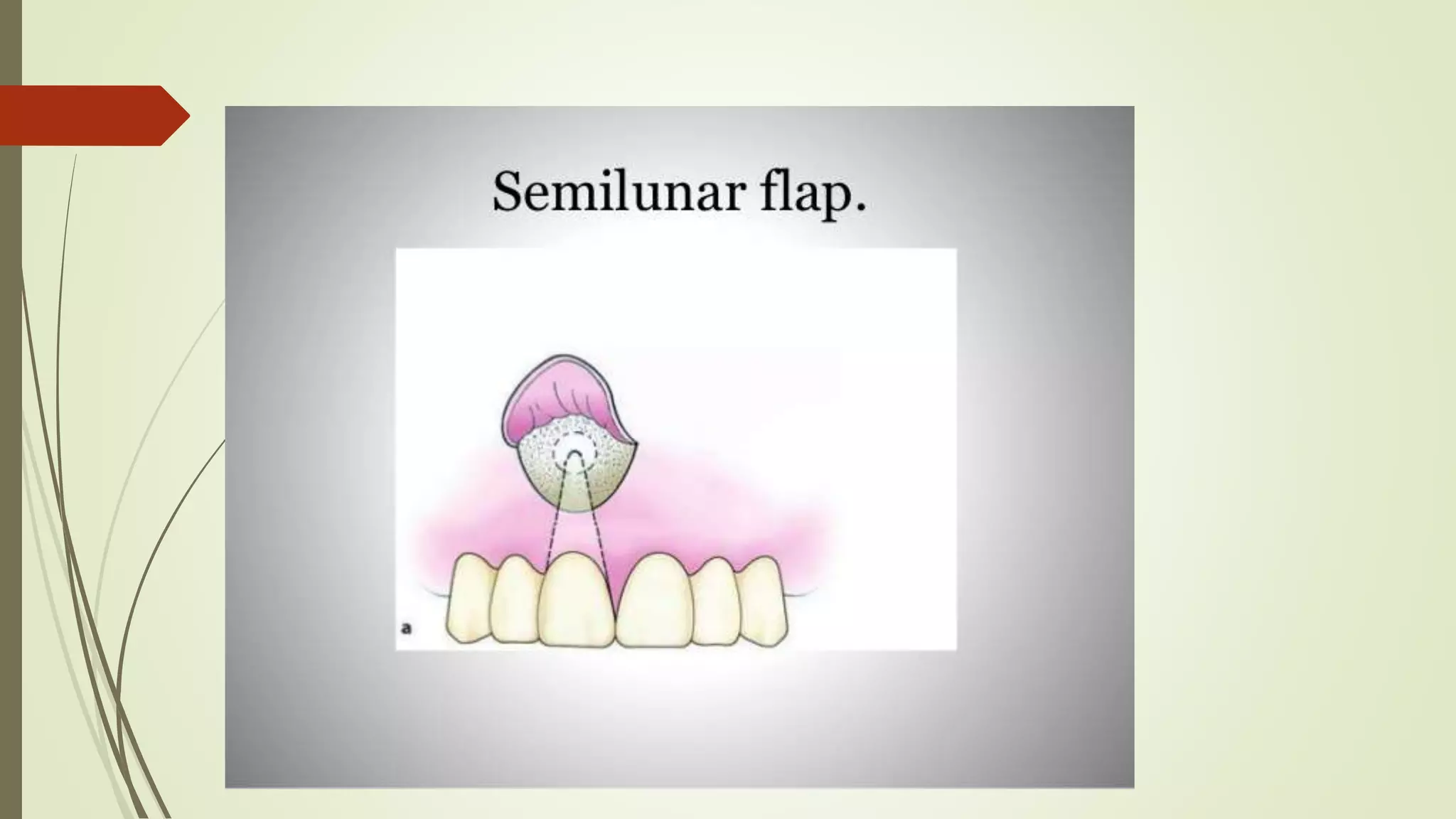 Flaps in oral surgery | PPTX