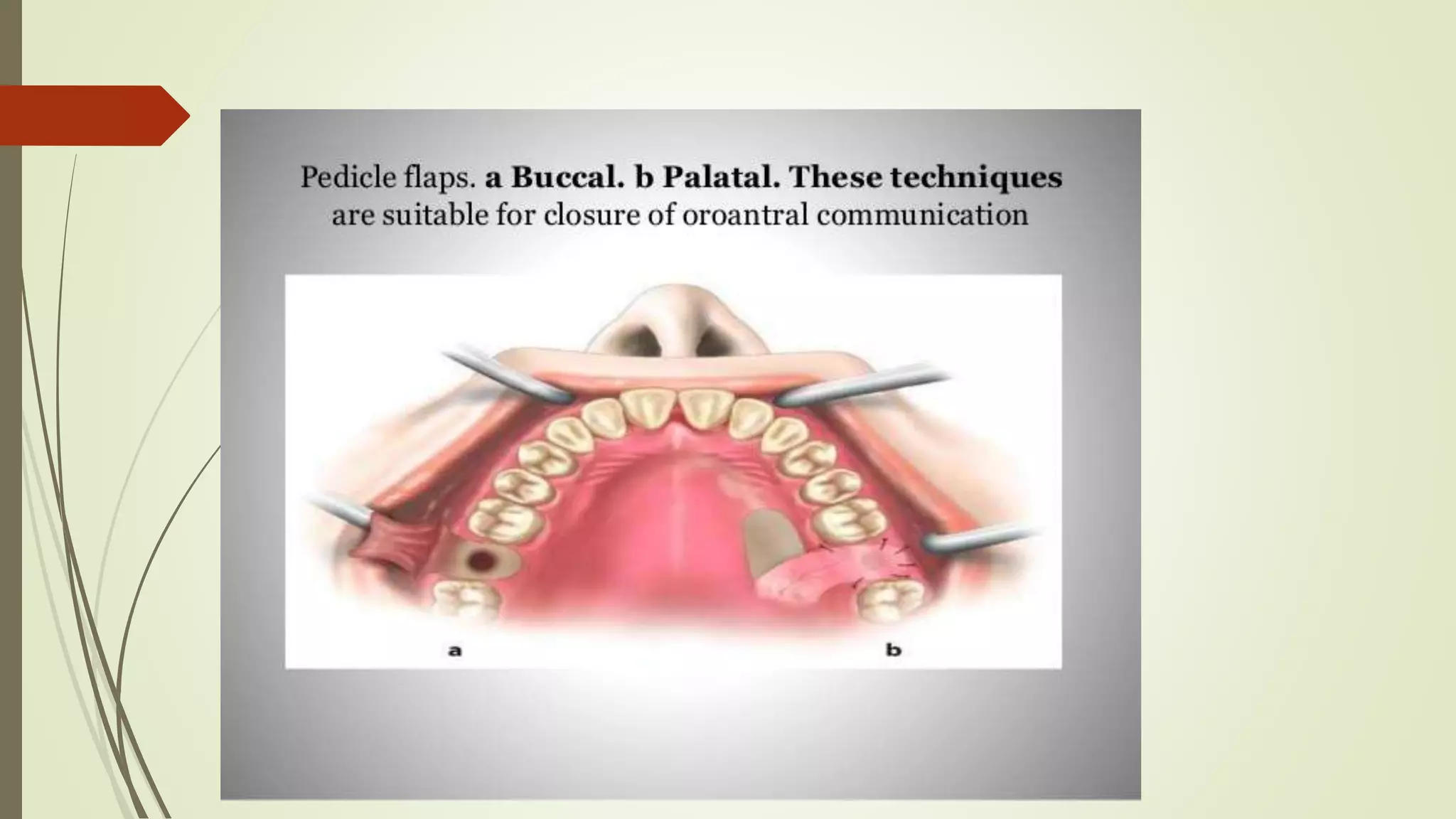 Flaps in oral surgery | PPTX