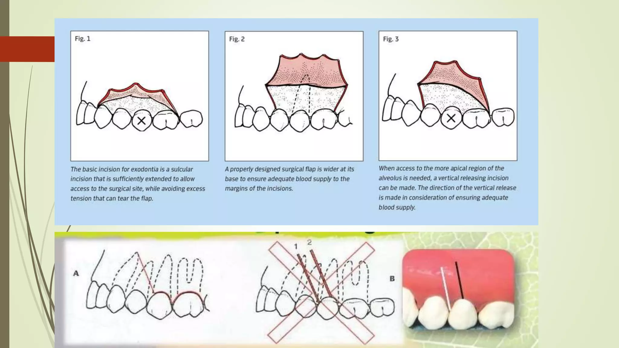 Flaps in oral surgery | PPTX