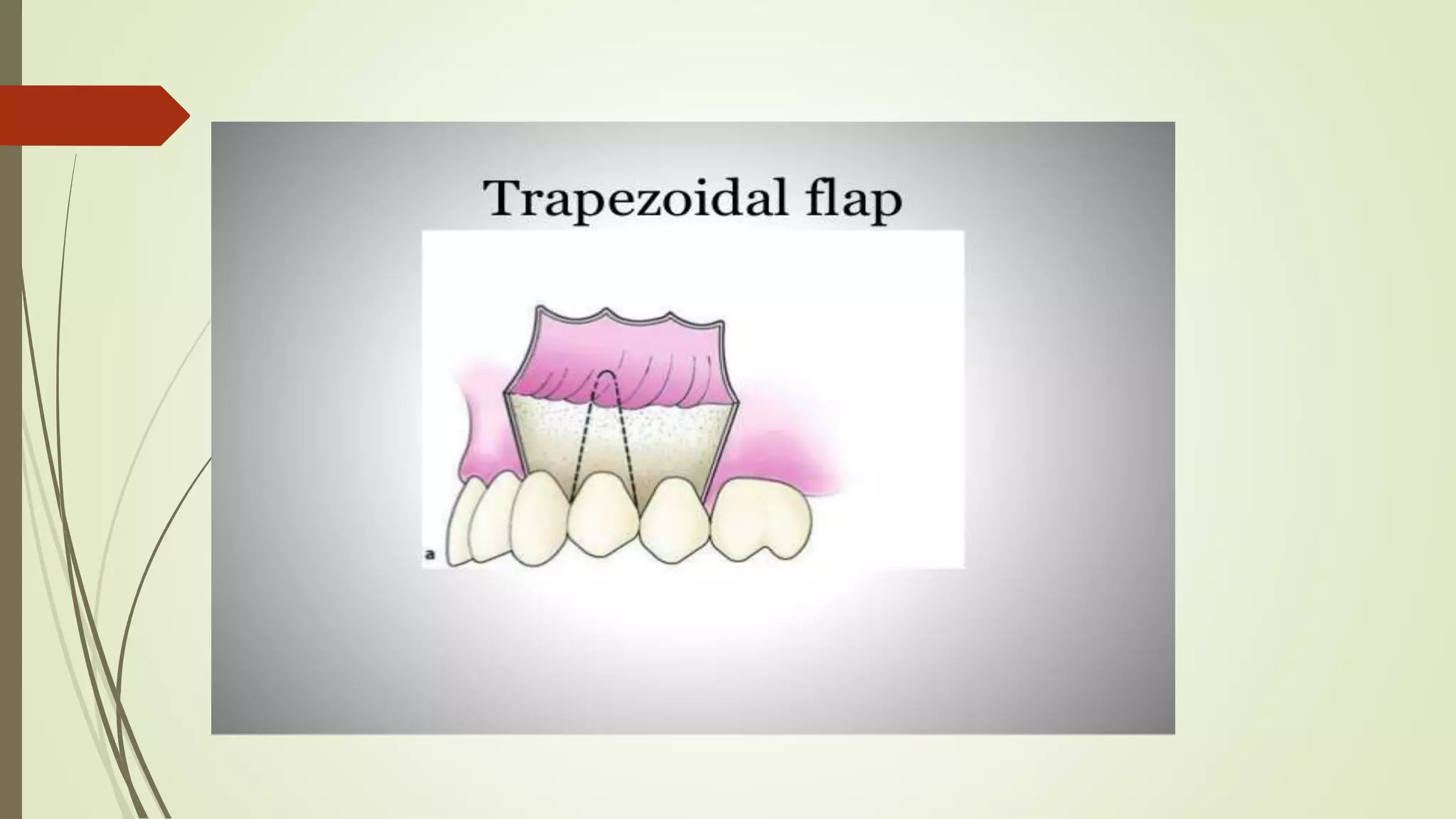 Flaps in oral surgery | PPTX