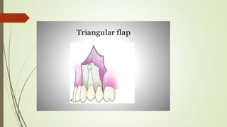 Flaps in oral surgery | PPTX