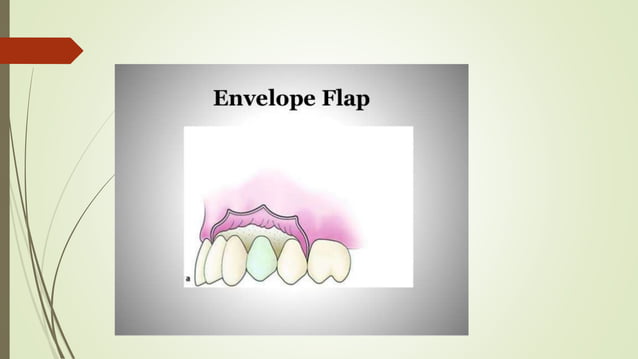 Flaps in oral surgery | PPTX | Dental Health | Diseases and Conditions
