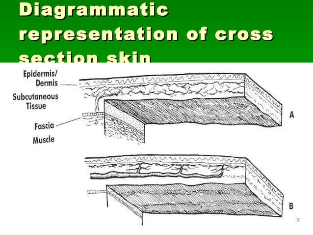 Flaps in orthopaedics | PPT