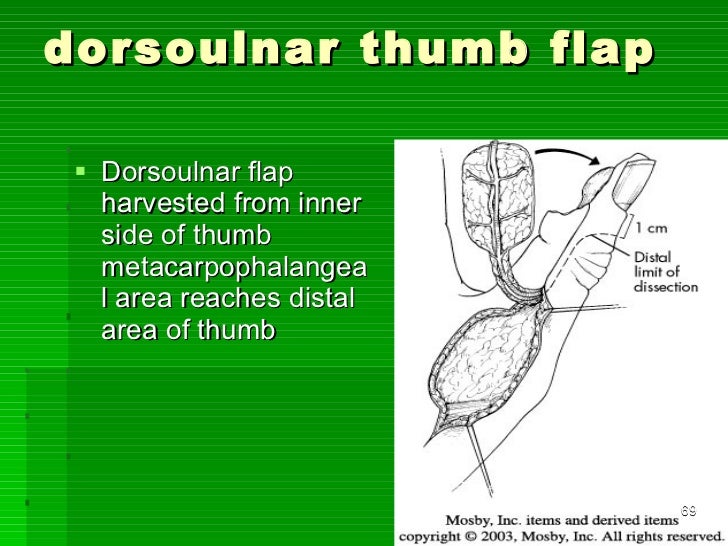Flaps in orthopaedics