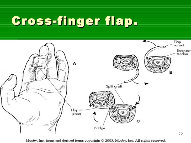 Flaps in orthopaedics