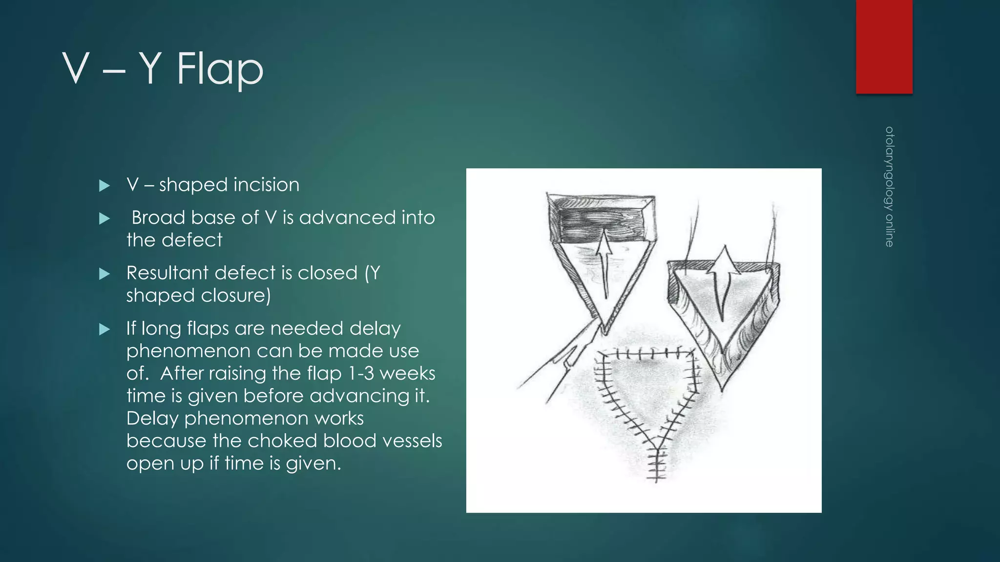 Flaps in otolaryngology | PPTX