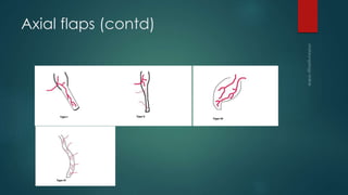 Flaps in otolaryngology | PPTX