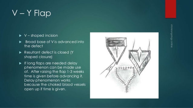Flaps in otolaryngology