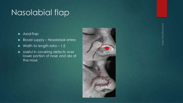 Flaps in otolaryngology