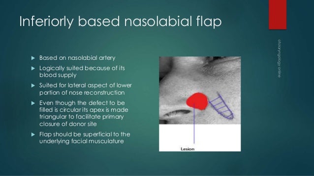 Flaps in otolaryngology