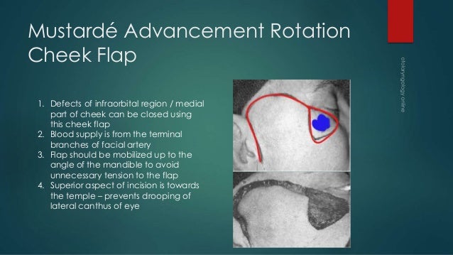 Flaps in otolaryngology