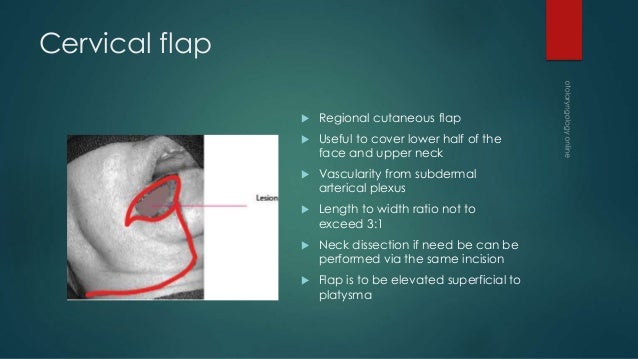 Flaps in otolaryngology