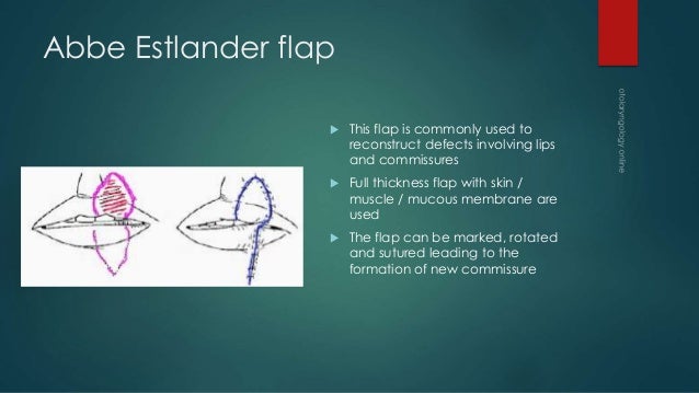 Flaps in otolaryngology