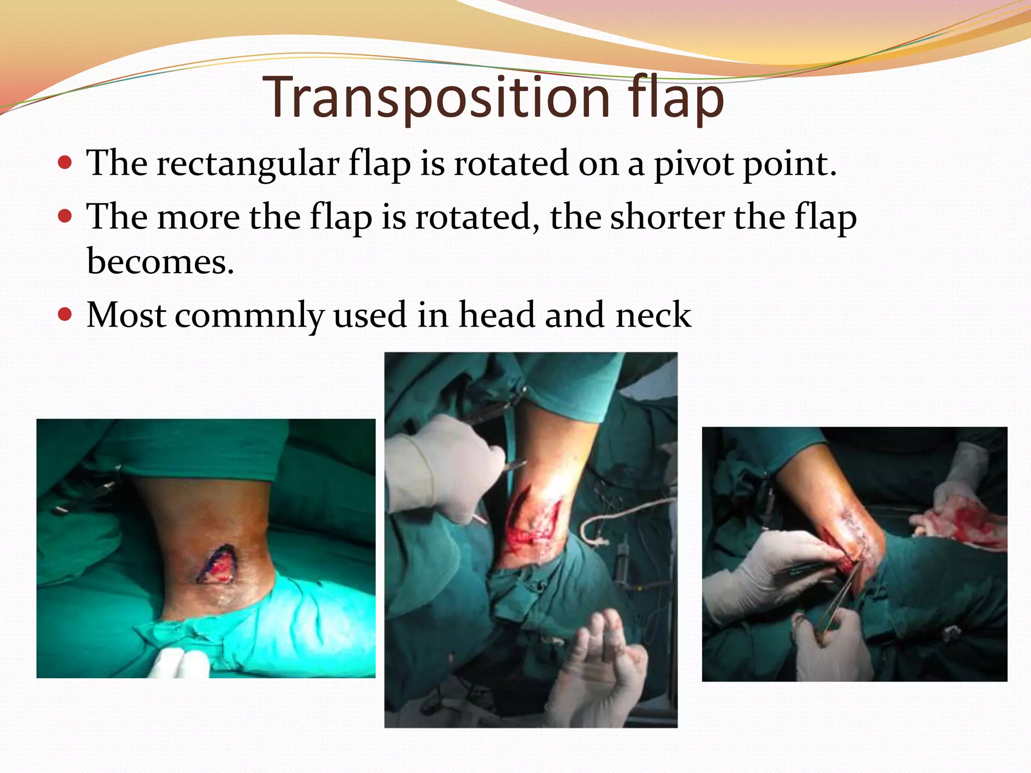 Flaps in plastic surgery | PPTX