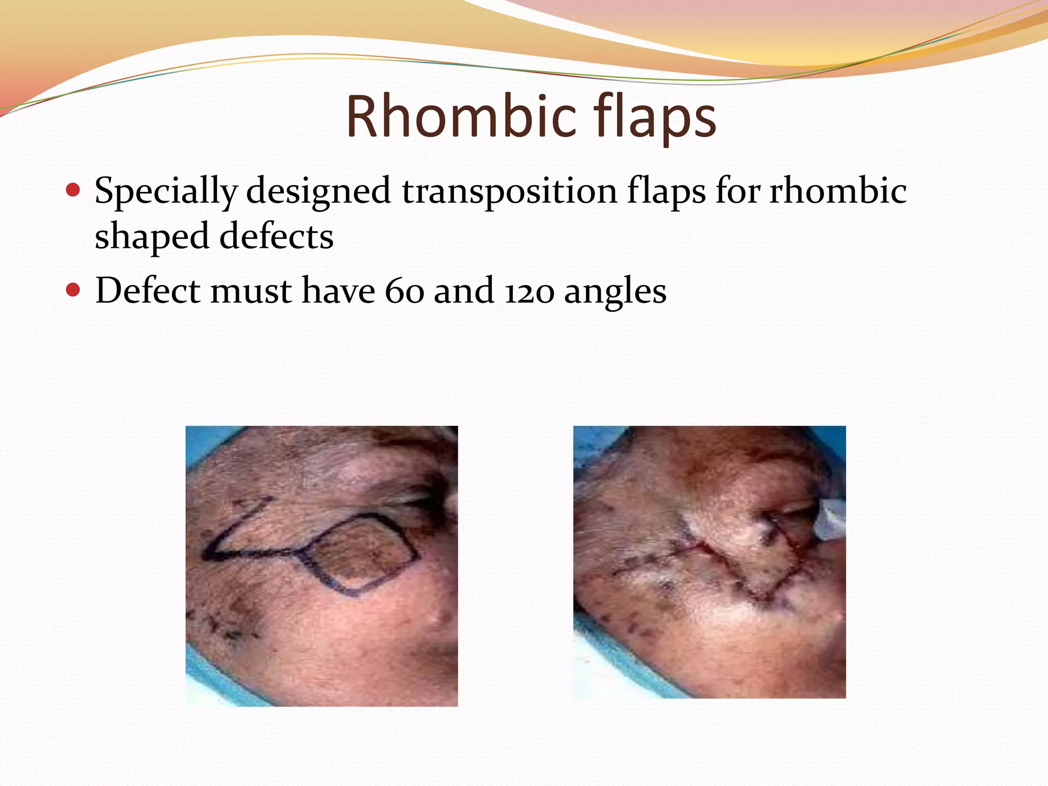 Flaps in plastic surgery | PPTX