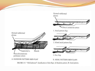 Flaps in plastic surgery | PPTX