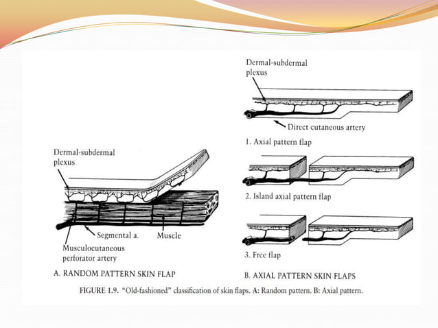 Flaps in plastic surgery | PPTX