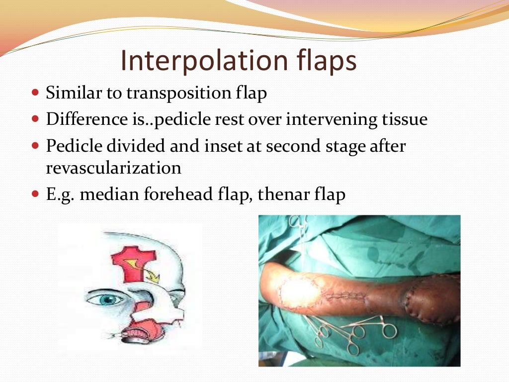 Flaps in plastic surgery