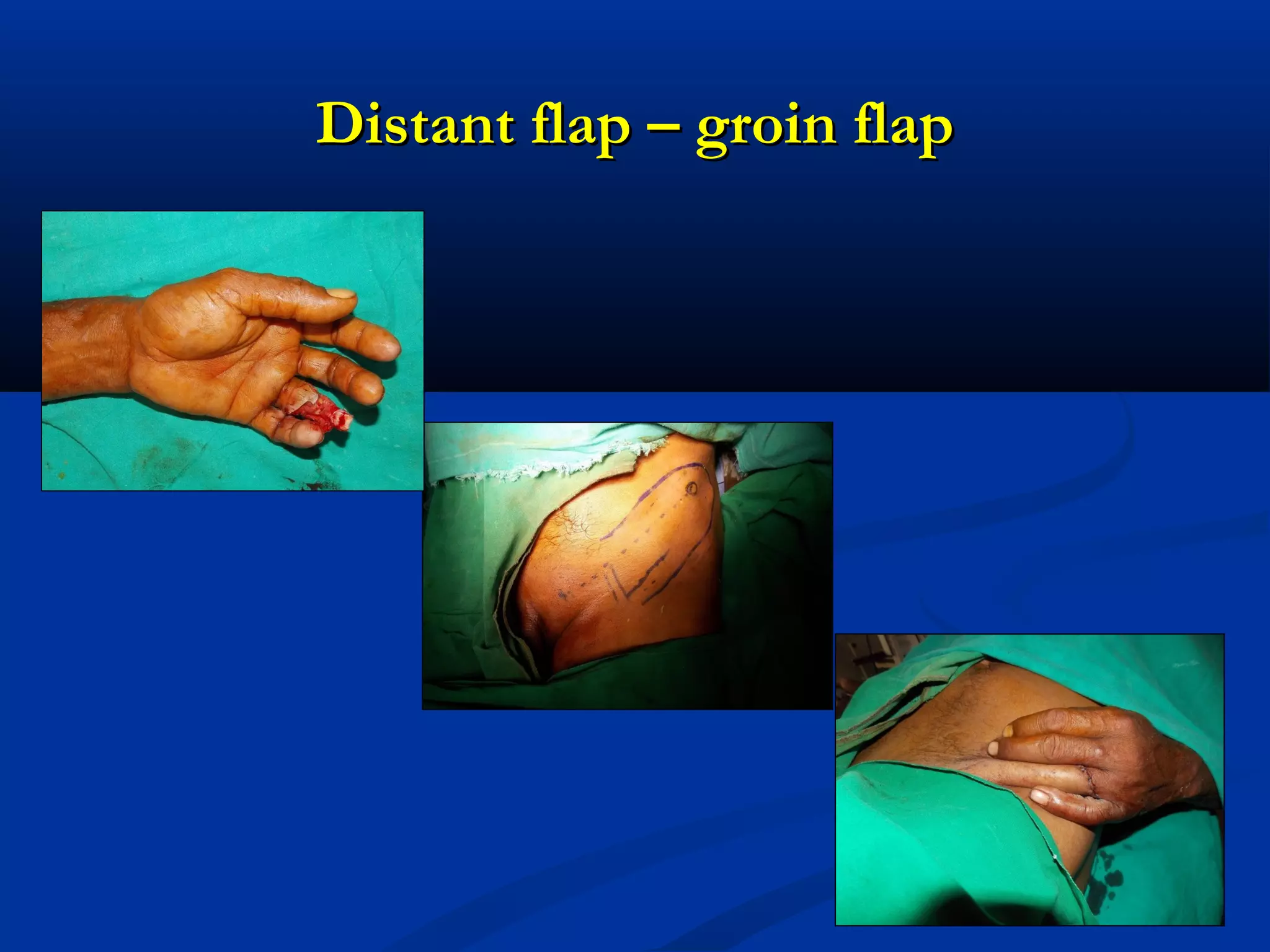 Flaps in plastic surgery | PPT