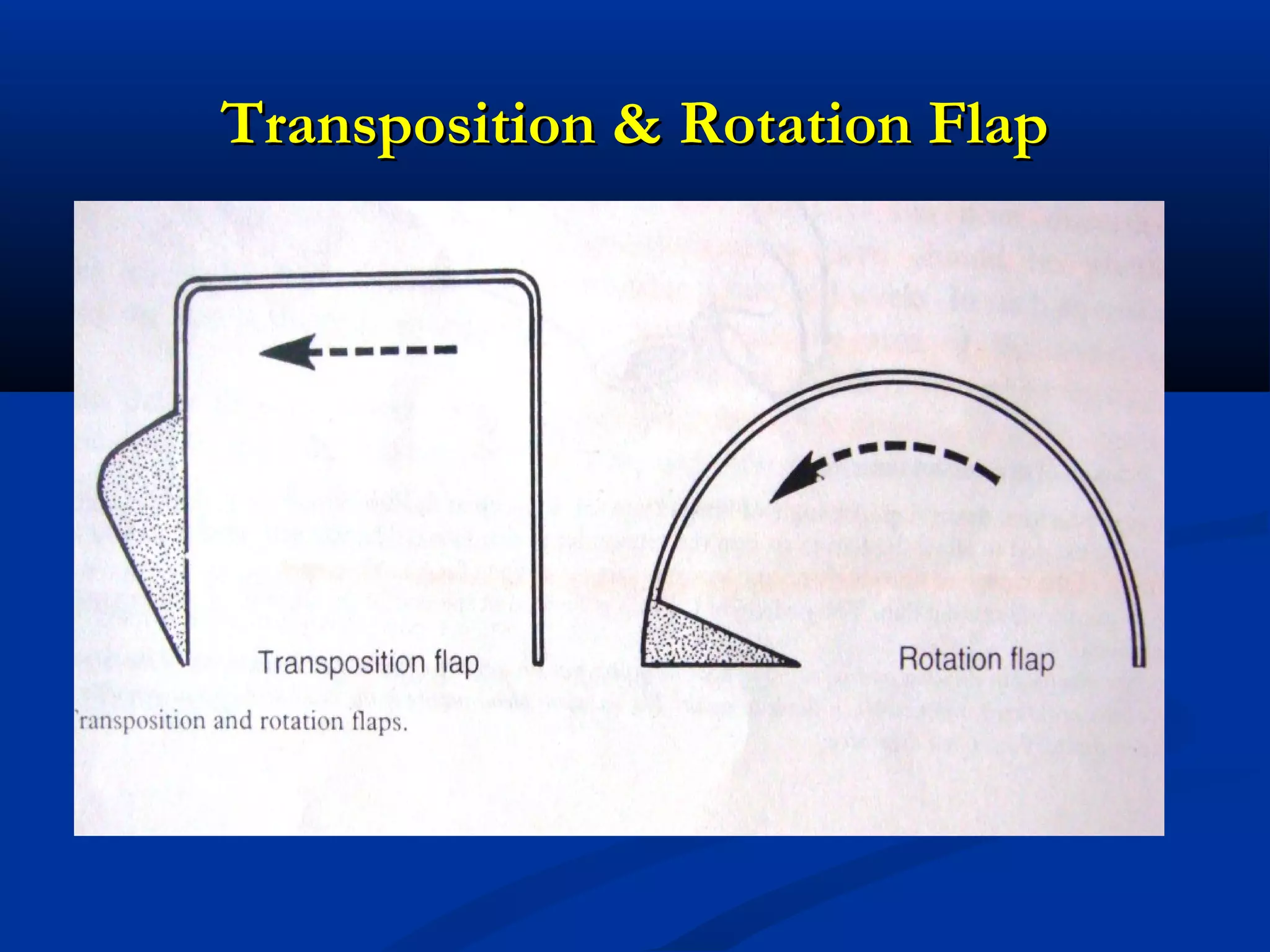 Flaps in plastic surgery | PPT