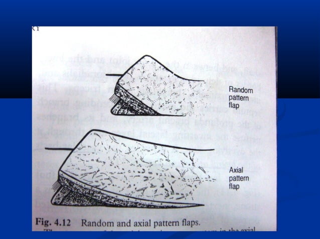 Flaps in plastic surgery | PPT | First Aid | Injuries