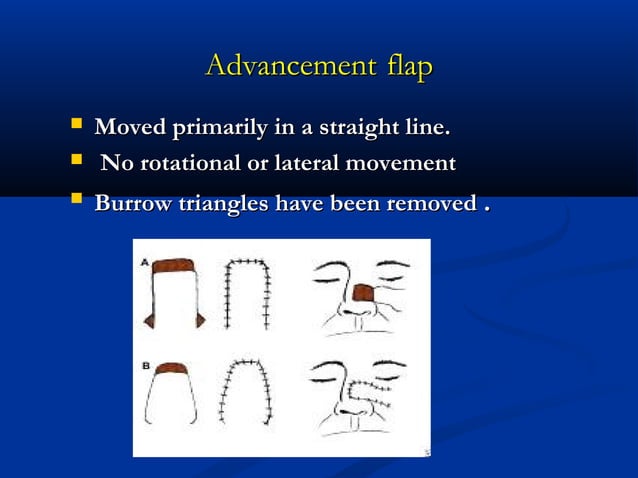 Flaps in plastic surgery | PPT | First Aid | Injuries