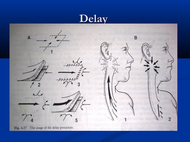Flaps in plastic surgery | PPT | First Aid | Injuries