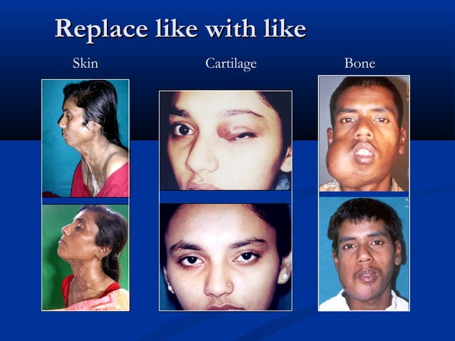 Flaps in plastic surgery | PPT | First Aid | Injuries