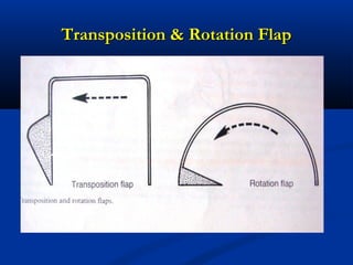 Flaps in plastic surgery | PPT