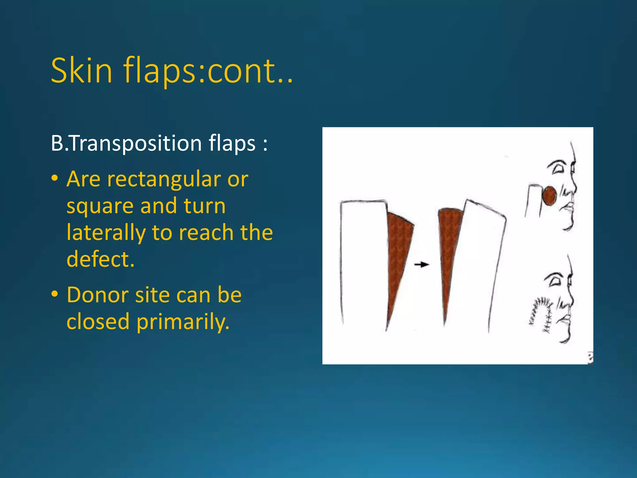 Flaps in surgery | PPTX