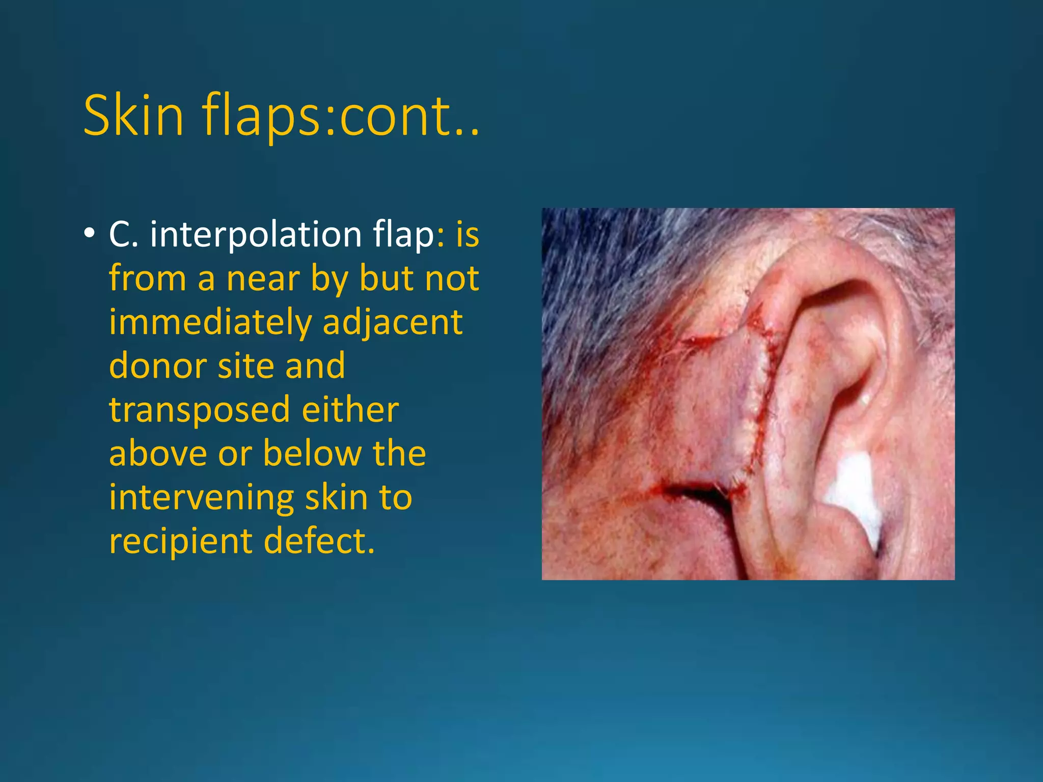 Flaps in surgery | PPTX