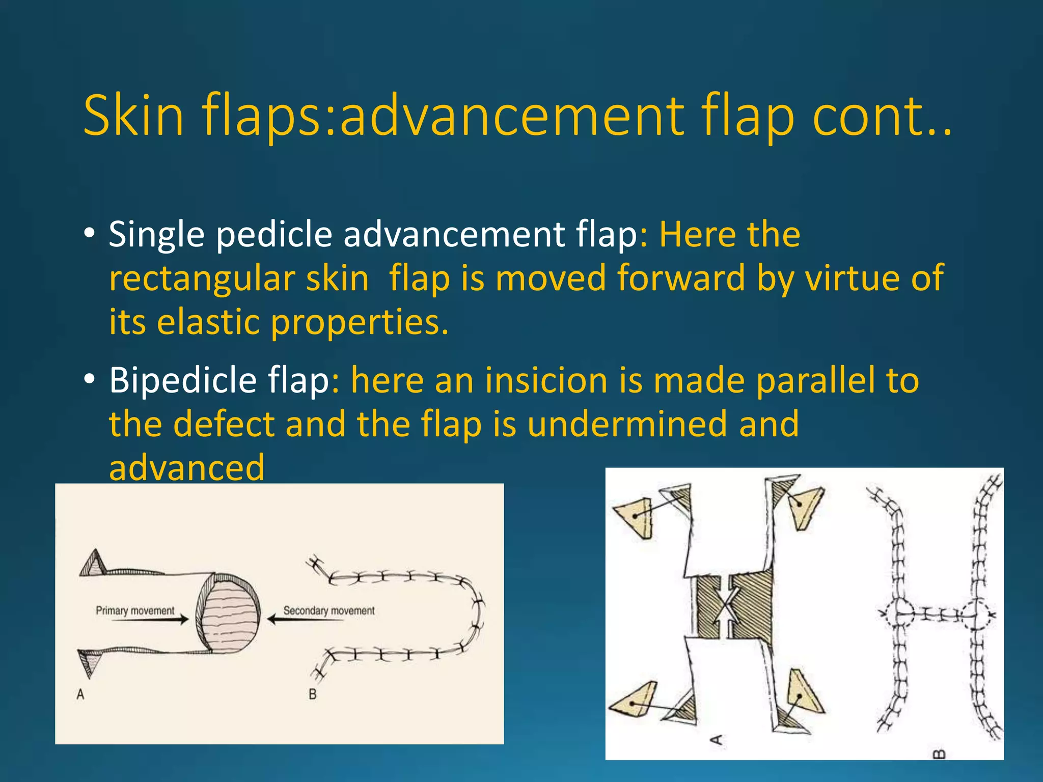 Flaps in surgery | PPTX