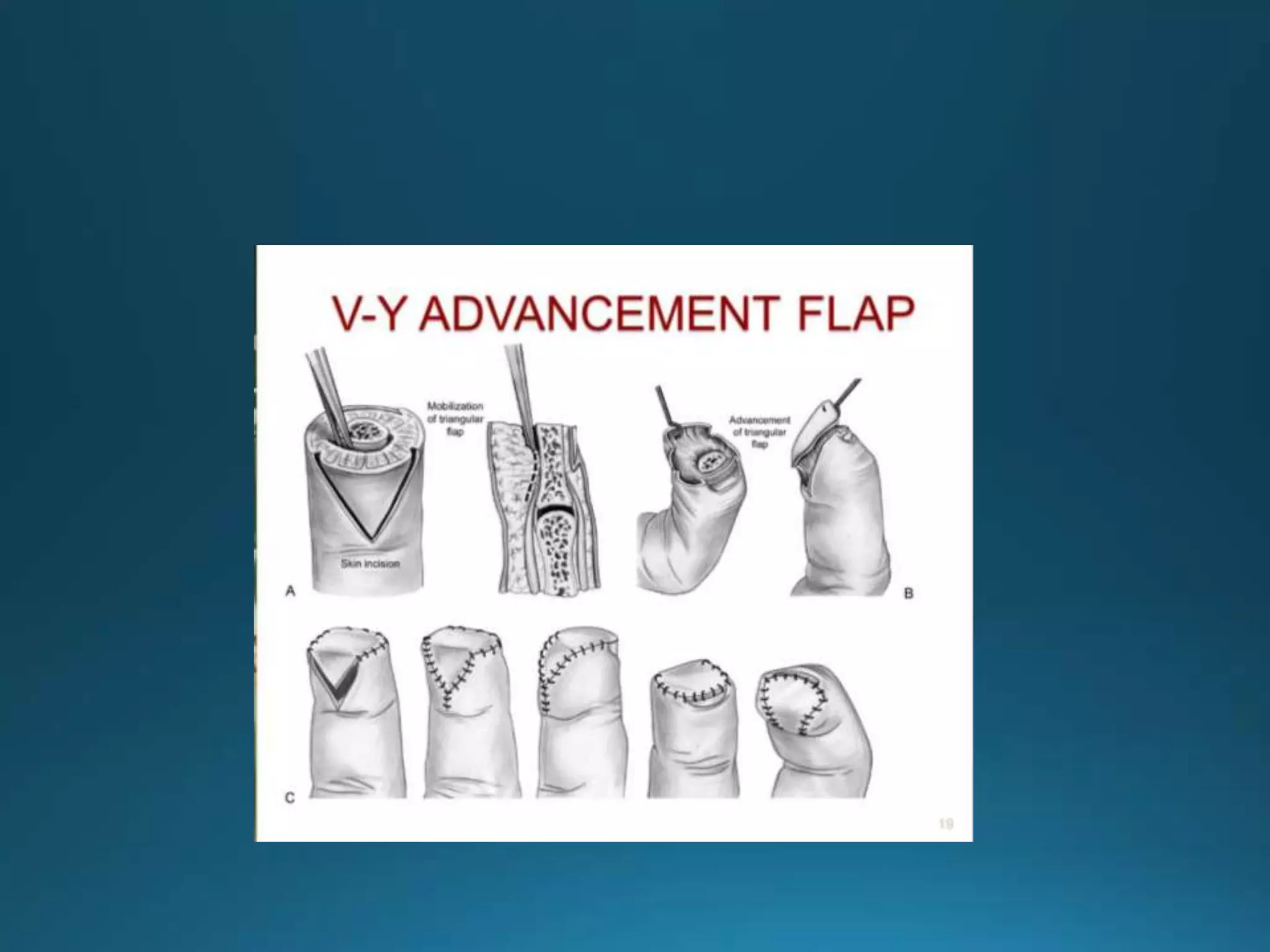 Flaps in surgery | PPTX