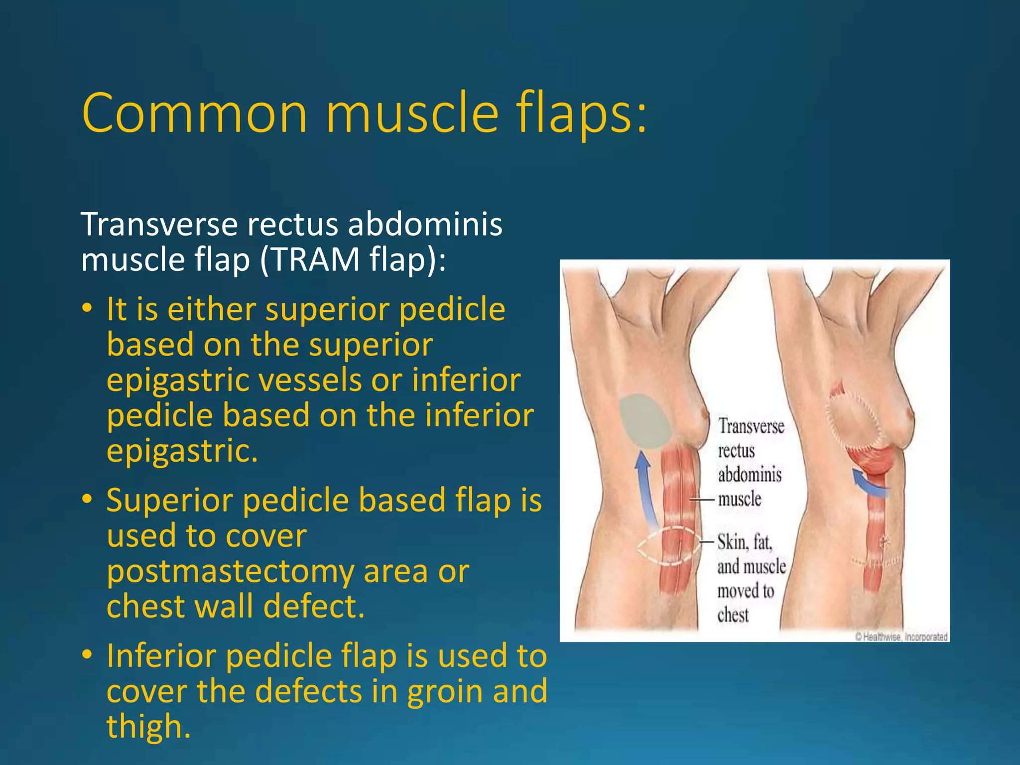 Flaps in surgery | PPTX