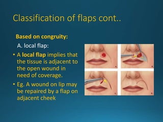 Flaps in surgery | PPTX