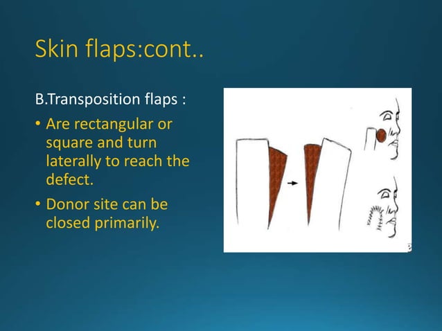 Flaps in surgery | PPTX