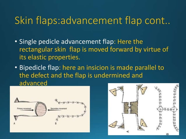 Flaps in surgery | PPTX