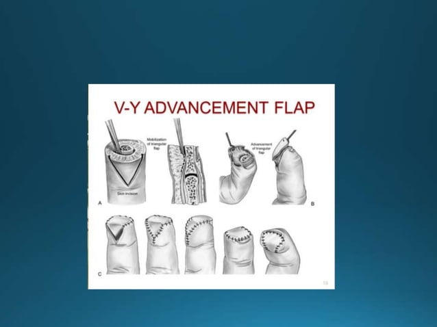Flaps in surgery | PPTX