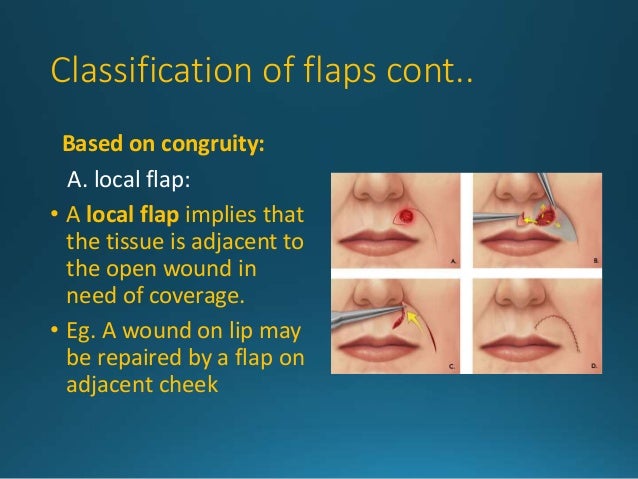 Types Of Flaps Plastic Surgery - Design Talk