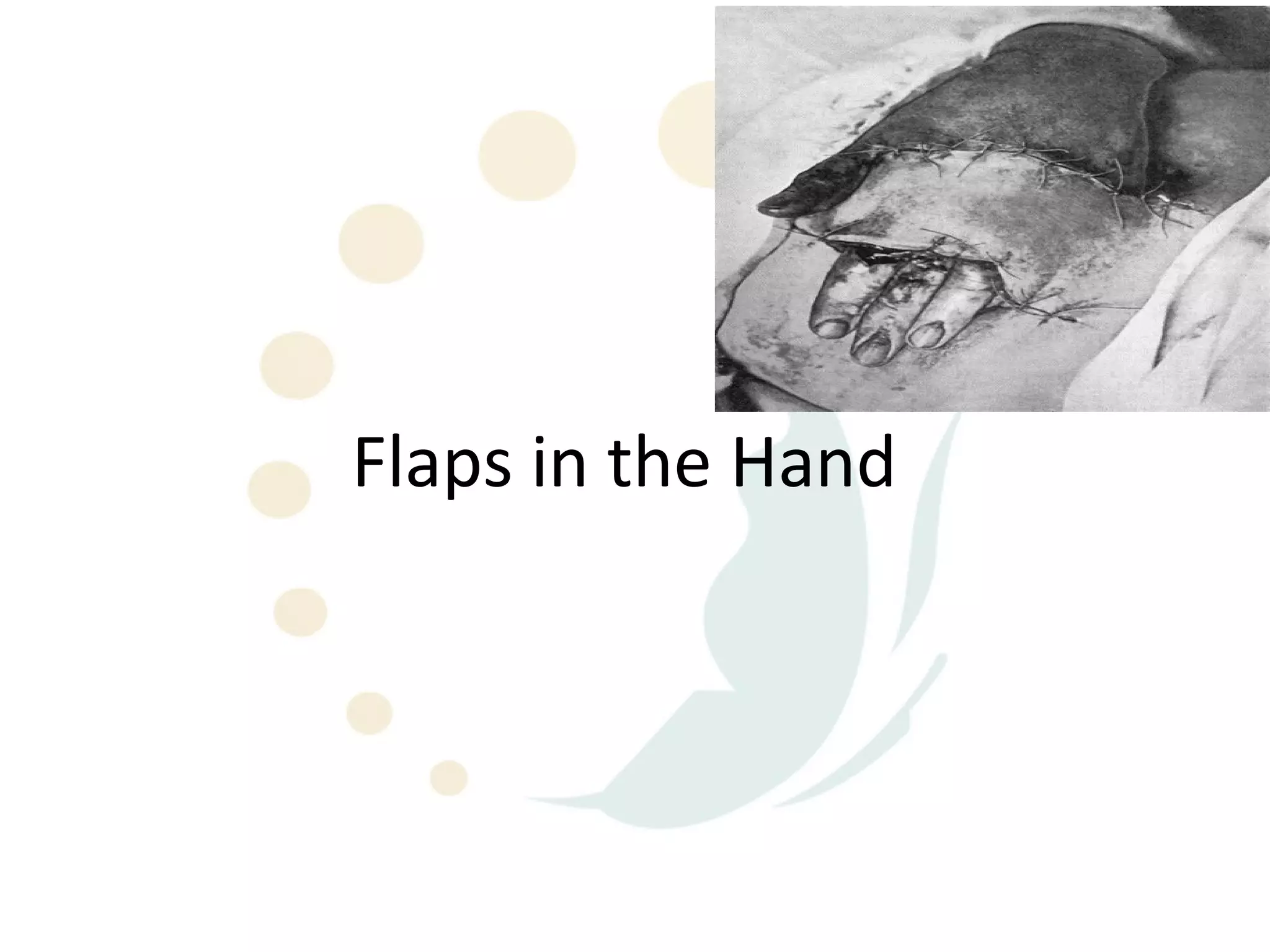 Flaps in the hand | PPT