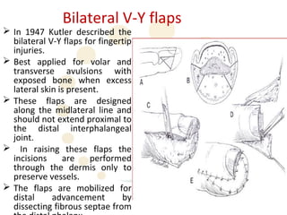 Flaps in the hand | PPT