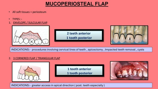 MASTERING FLAPS IN ORAL & MAXILLOFACIAL SURGERY | PPT
