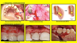 MASTERING FLAPS IN ORAL & MAXILLOFACIAL SURGERY | PDF