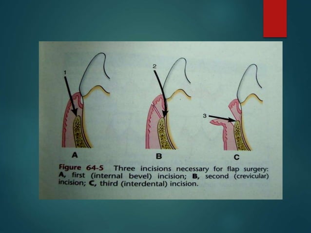 Flap surgery | PPTX