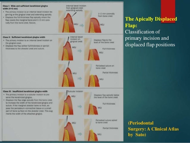 Flap surgery