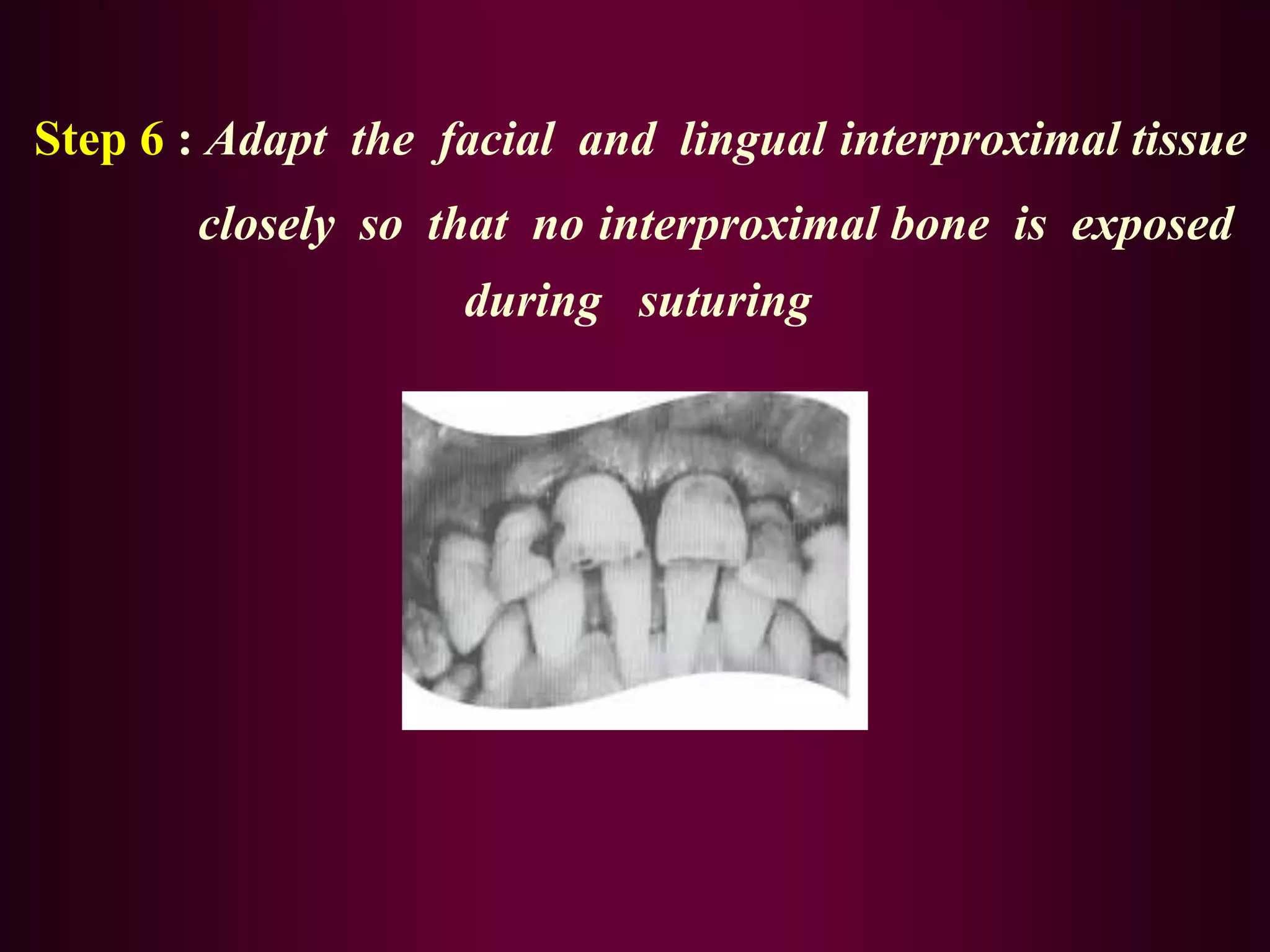 FLAP TECHNIQUE.ppt