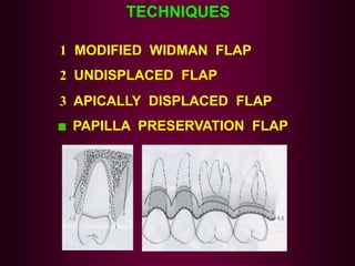 FLAP TECHNIQUE.ppt