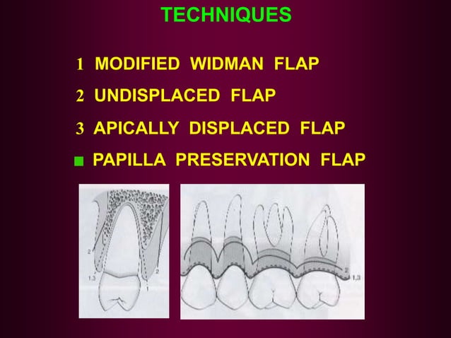 FLAP TECHNIQUE.ppt